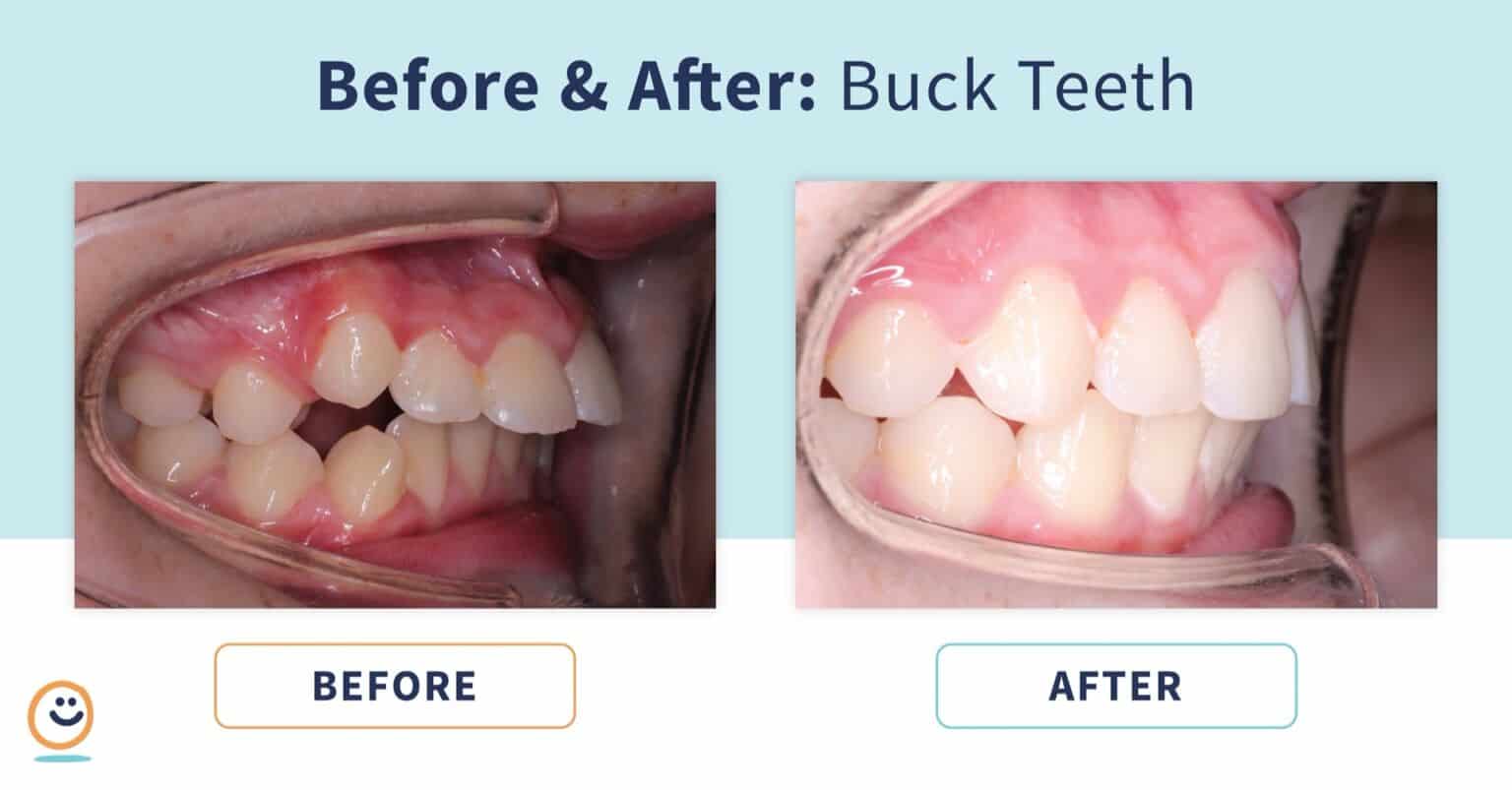 Braces: Before and After Buck Teeth