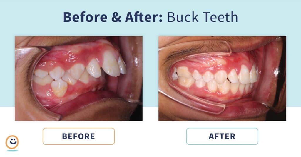 Braces: Before and After Buck Teeth