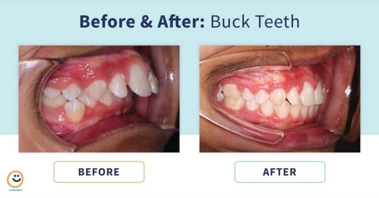Braces: Before and After Buck Teeth